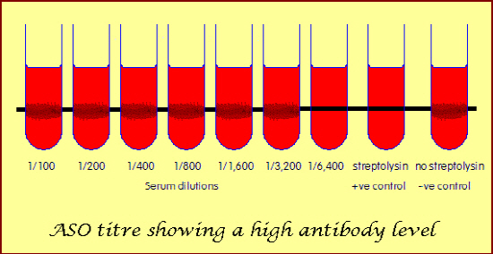 사슬알균 감염에서 증가하는 Antistreptolysin O antibody (ASO)의미