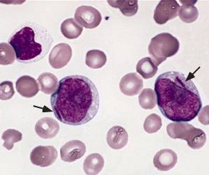 급성골수성백혈병 - Auer rods or Auer bodies